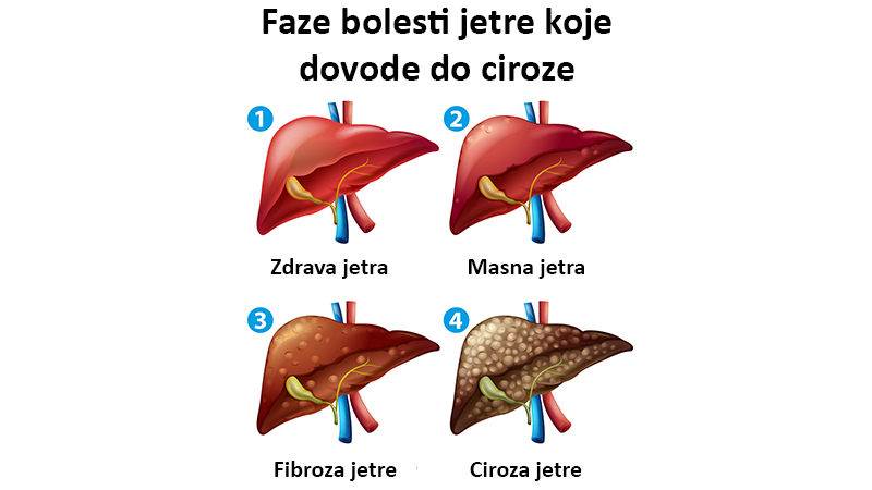 Šta je fibroza jetre: Simptomi, uzroci i prirodni lekovi - Biovital